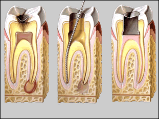 endodoncia: Fases del tratamiento endodóntico